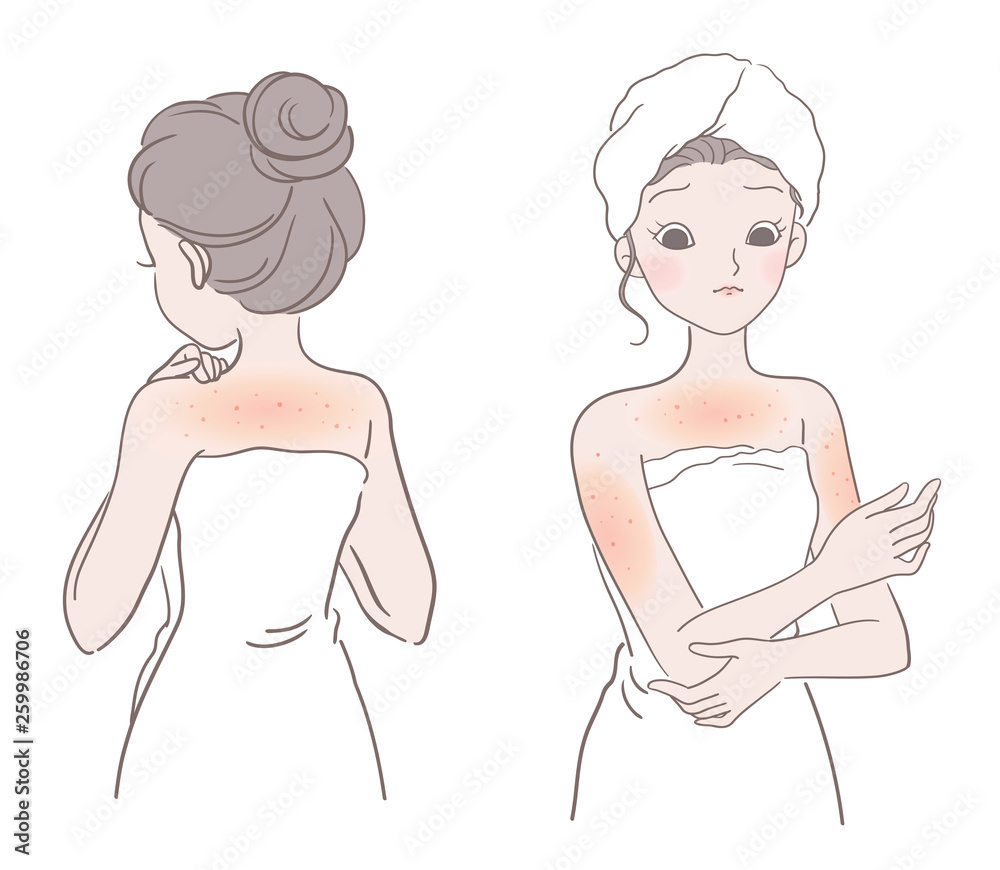 Folliculitis on a woman's skin Stock Vector | Adobe Stock