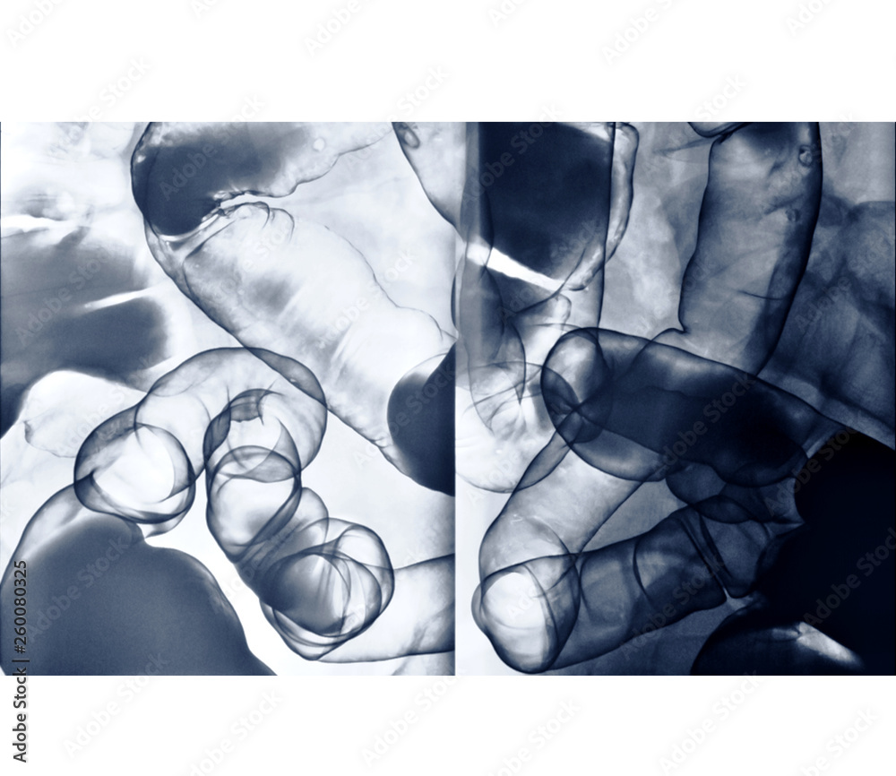 barium enema image or x-ray image of large intestine or colon showing ...