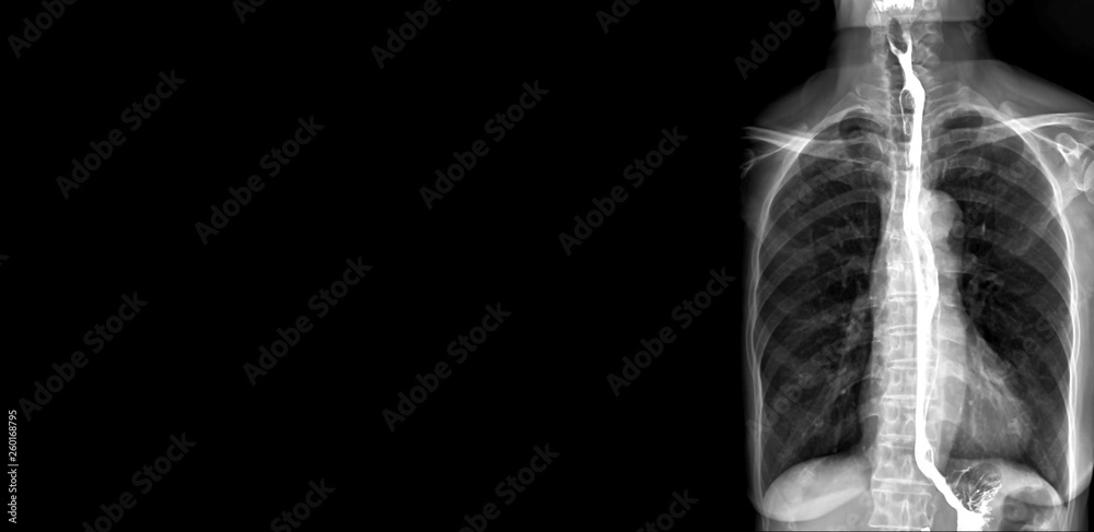 Esophagus Cancer X Ray