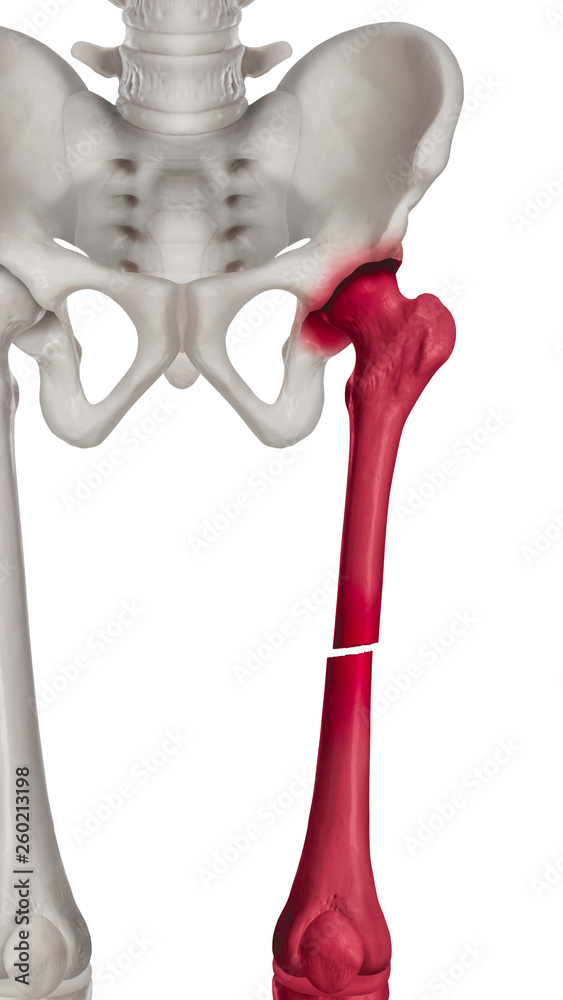 Broken upper leg or thigh bone- femur fracture anterior view completed ...