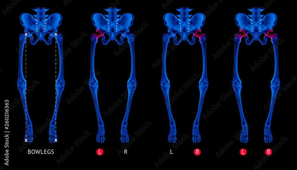 Varus alignment of leg or Bowlegs bone X-ray blue film collection with ...