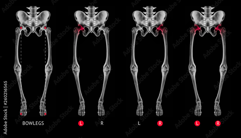 Varus alignment of leg or Bowlegs bone X-ray film collection with red ...