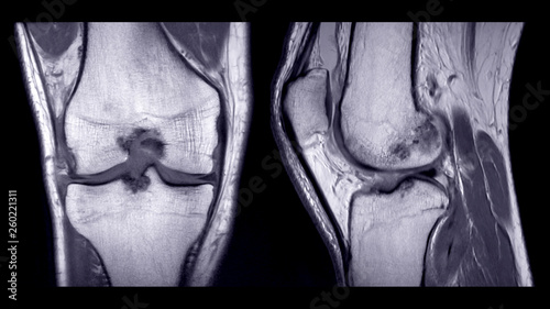 Magnetic resonance imaging or MRI of right knee comparison coronal and ...
