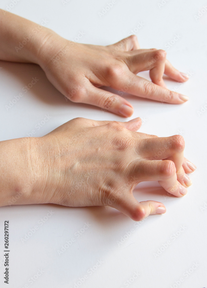Young woman's hands deformed from Rheumatoid Arthritis. Stock Photo ...
