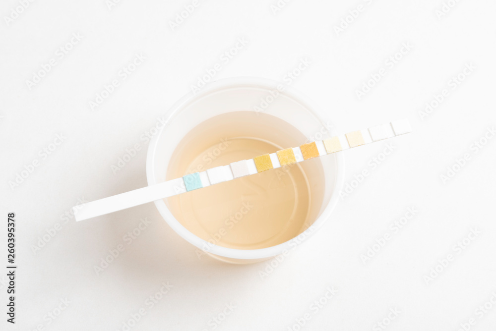 A set of urine sample on a round plastic cup with a single unused urine ...