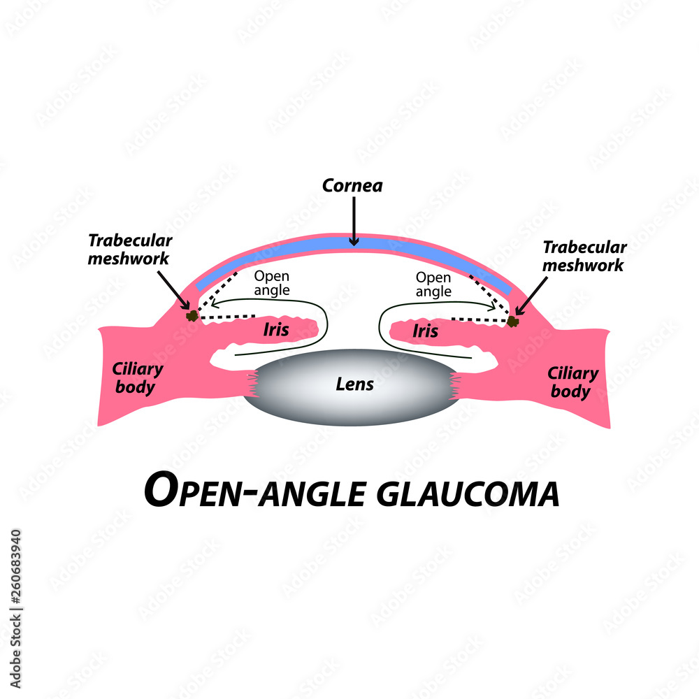 Open-angle glaucoma. A common type of glaucoma. The anatomical ...