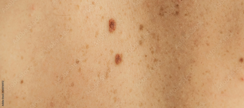 Close up detail of the bare skin on a man back with scattered moles and ...