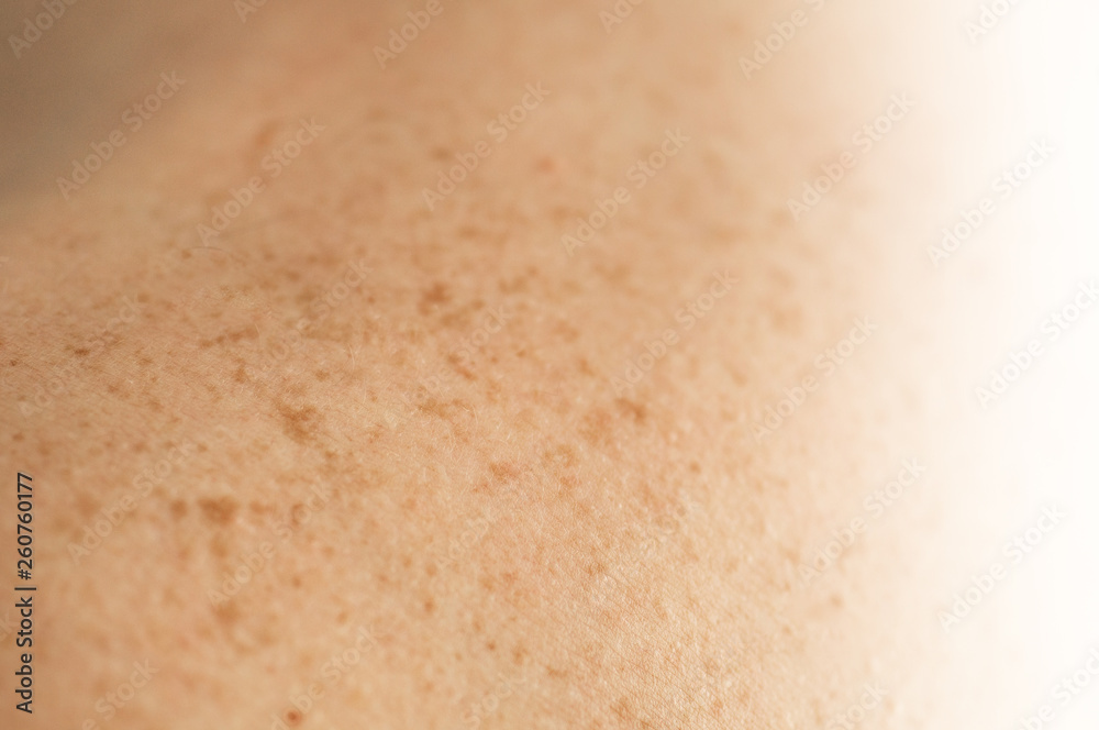 Close up detail of the bare skin on a man back with scattered moles and ...