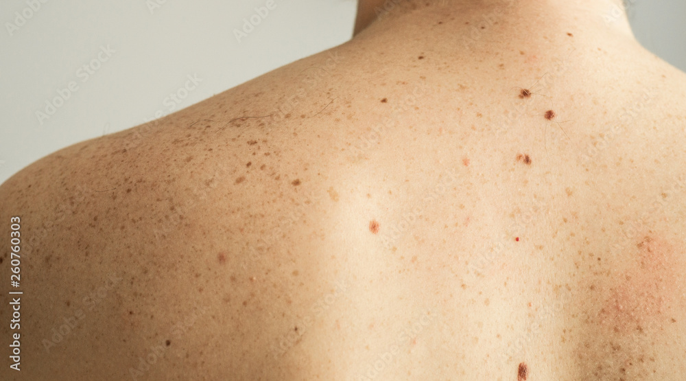 Close up detail of the bare skin on a man back with scattered moles and ...