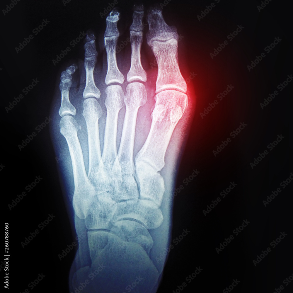 bursitis of the big toe. Callus on the leg. X-ray of the foot with the ...
