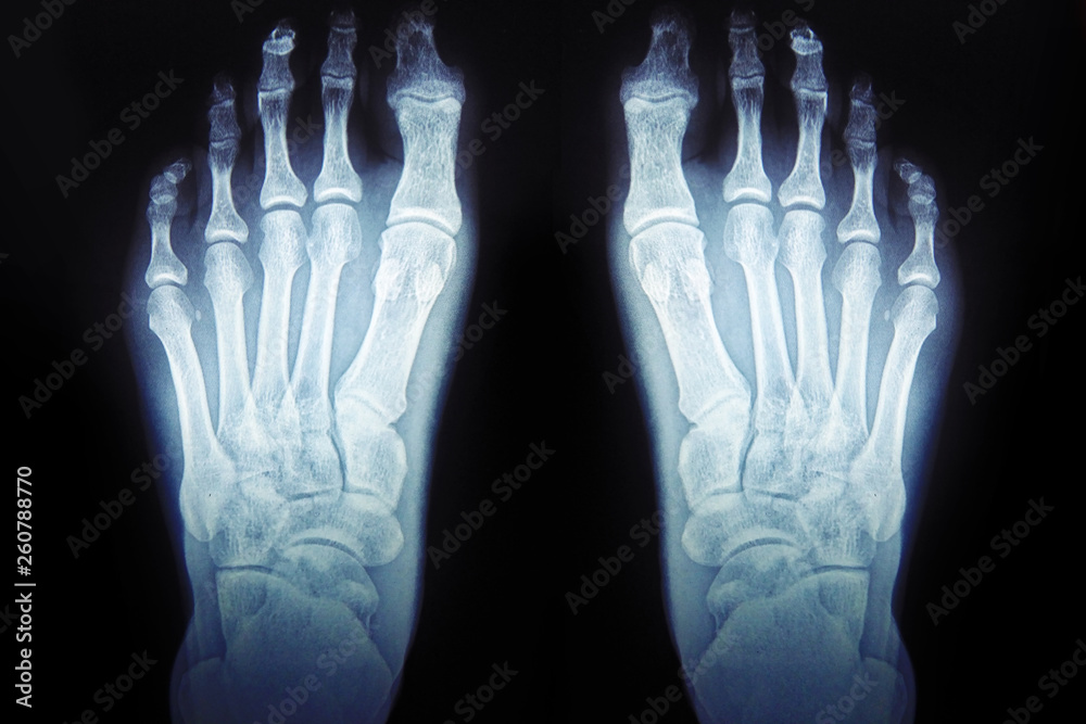 X-rays of the foot, human foot medical diagnostics. Stock Photo | Adobe ...