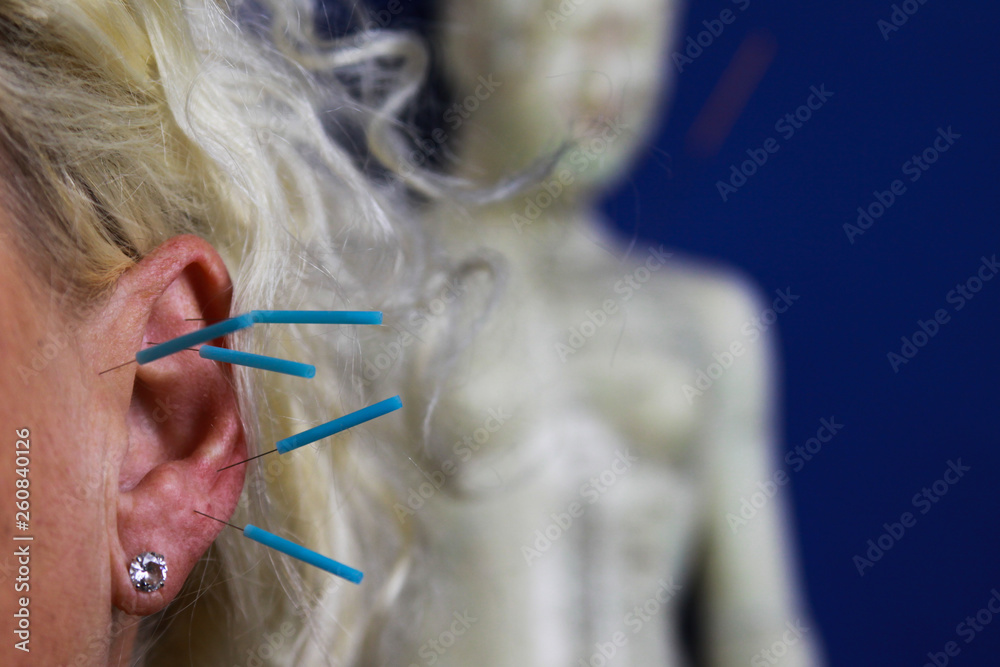 Close up of human female ear with blue needles: Ear acupuncture as a ...