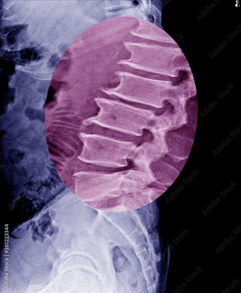 Lumbar spine x-ray show spur of vertebral body. Stock Photo | Adobe Stock