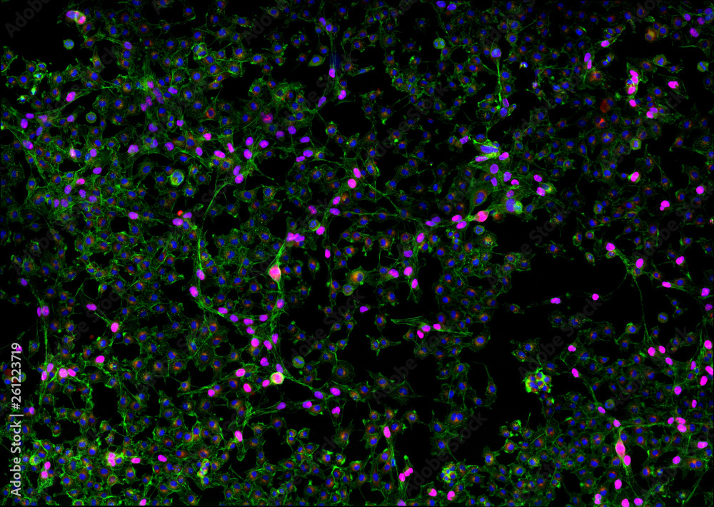 Real fluorescence microscopic view of cancer cells - human melanoma ...