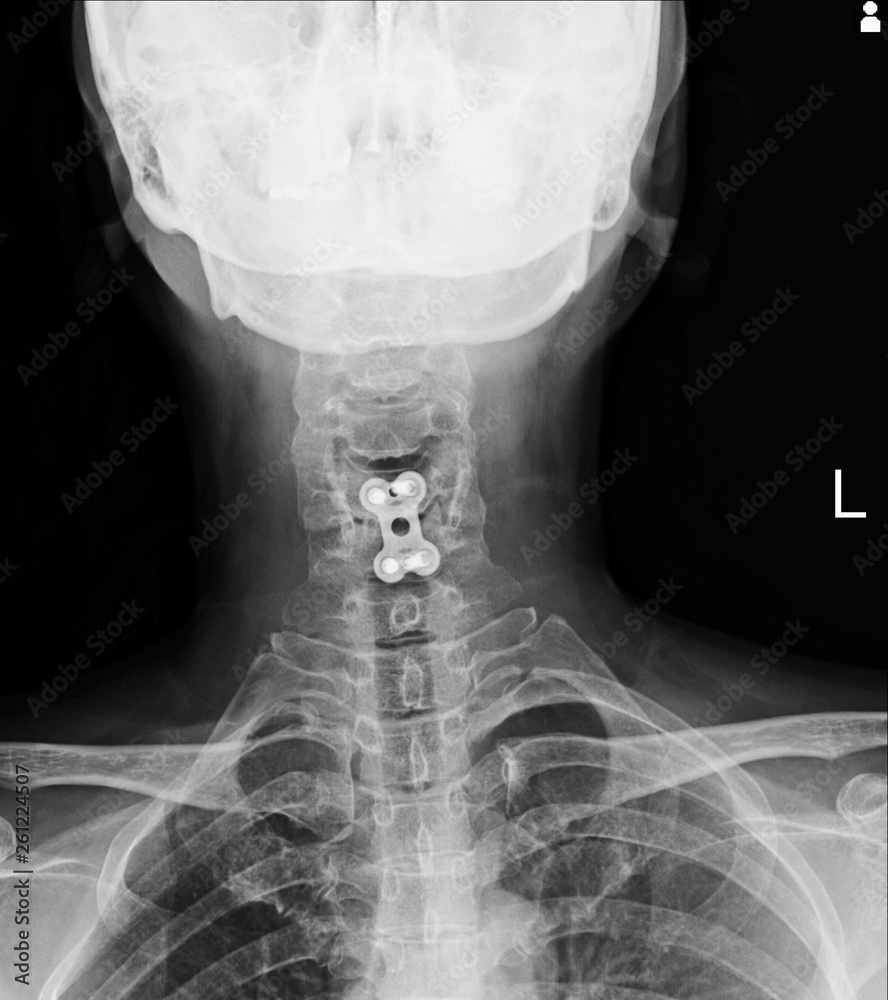 x-ray cervical spine fication of C5-6 bodies No spinal dislocation ...