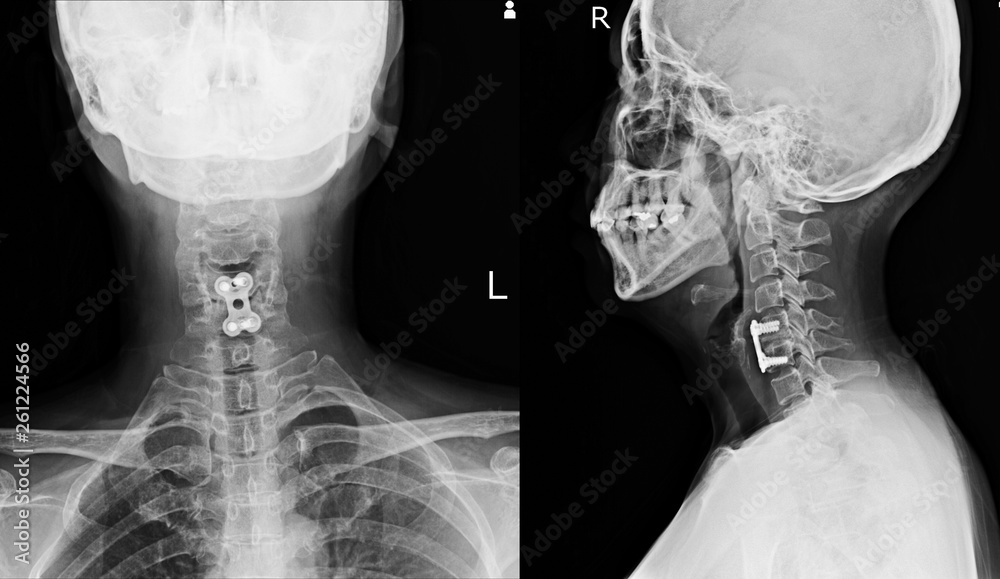x-ray cervical spine showing post operation internal fixation C4-C5 and ...