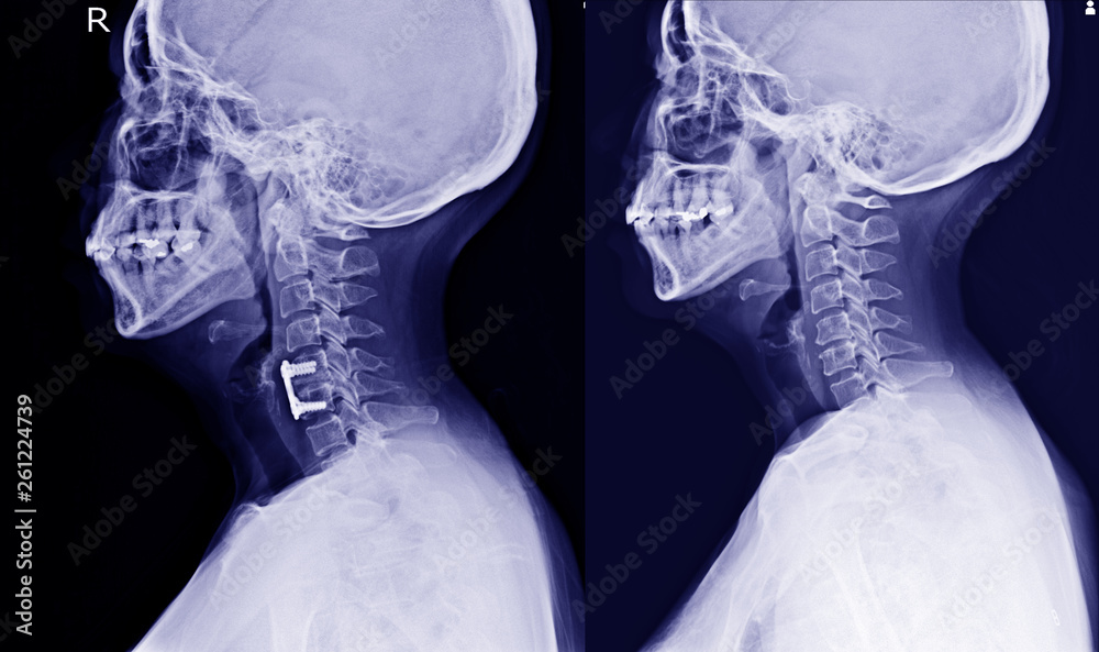 X-ray C-SPINES show post operation internal fixation C4-C5 & C6 with ...