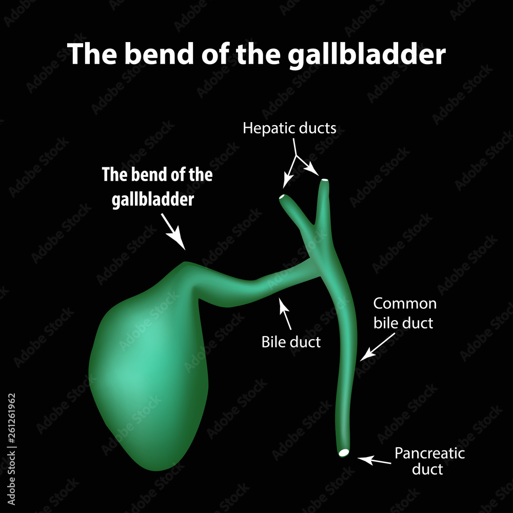 The bend of the gallbladder. Pathology of the gallbladder ...