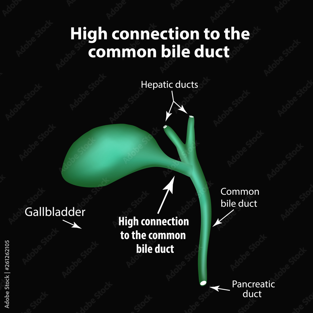 High connection to the common bile duct. Pathology of the gallbladder ...