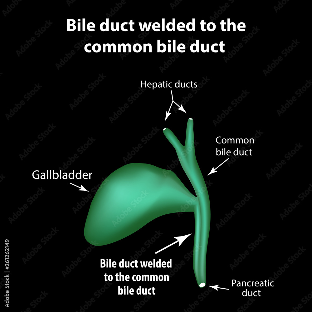 Vetor de Bile duct welded to the common bile duct. Pathology of the ...