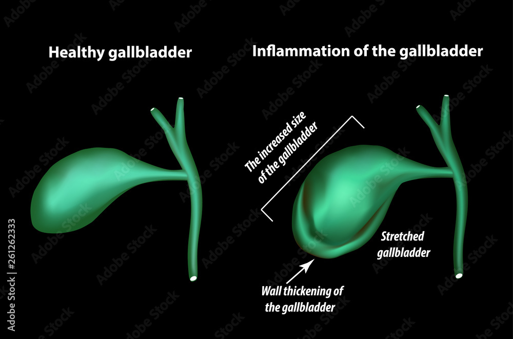 Symptoms of gallbladder inflammation. Cholecystitis. Thickening of the ...