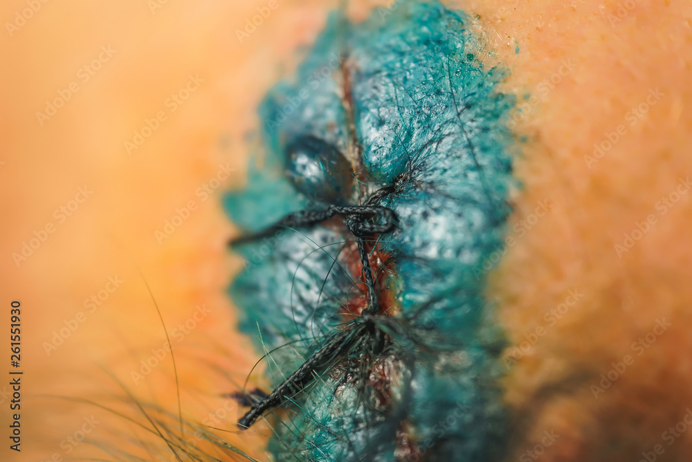 Head wound after a car accident. Brilliant green solution on the ...