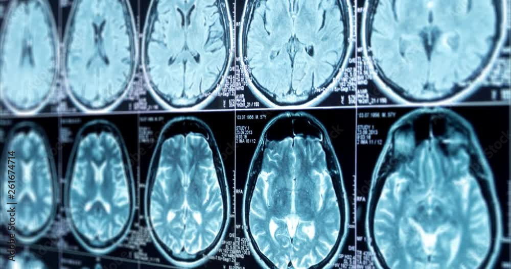 MRI scan of the brain close up scroll up, looped Stock Video | Adobe Stock