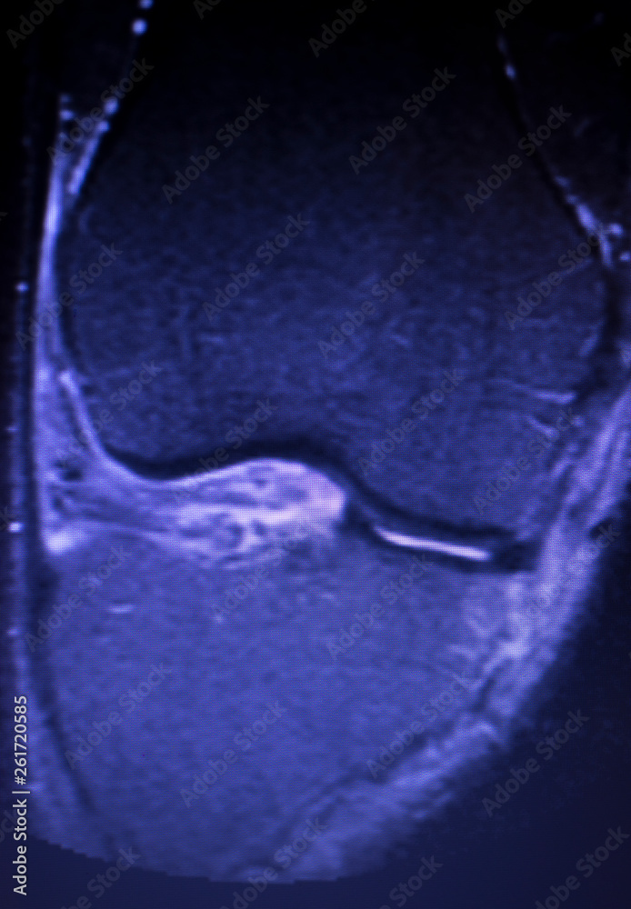 MRI knee meniscus tear scan Stock Photo | Adobe Stock