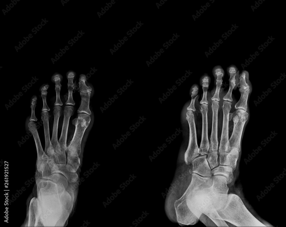 foot x-ray AP and lateral view Stock Photo | Adobe Stock