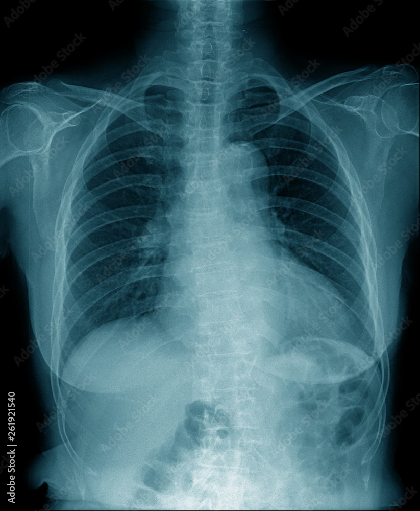 chest x-ray , hight quality chest x-ray image in blue tone Stock Photo ...