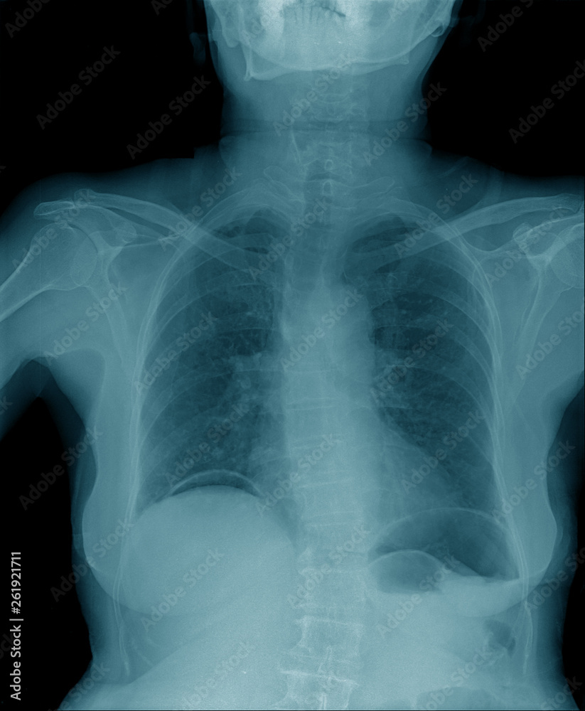 chest x-ray , hight quality chest x-ray image in blue tone Stock Photo ...