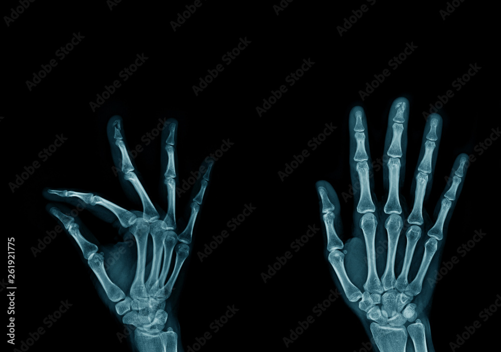 x-ray image hand and finger, action of hand and finger x-ray Image in ...