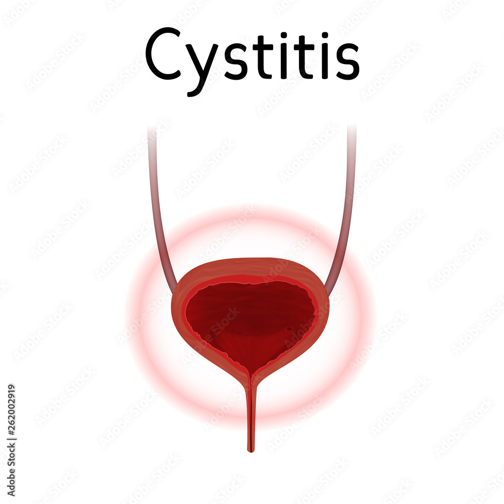 Anatomy picture of bladder infection, pain. Cistitis. Realistic medical ...