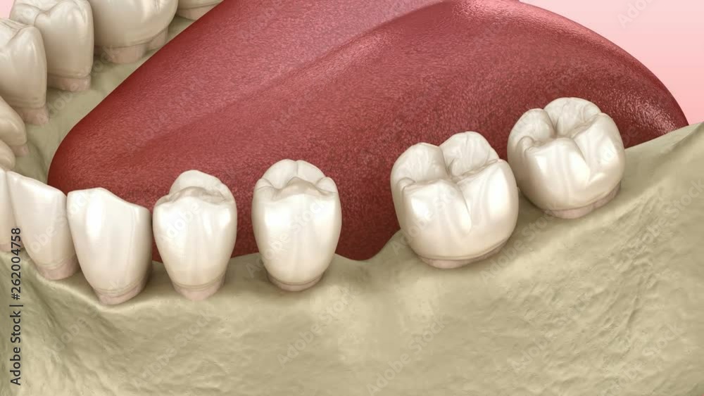 Video „Teeth shift deformatiuon after losing molar tooth. 3D animation ...
