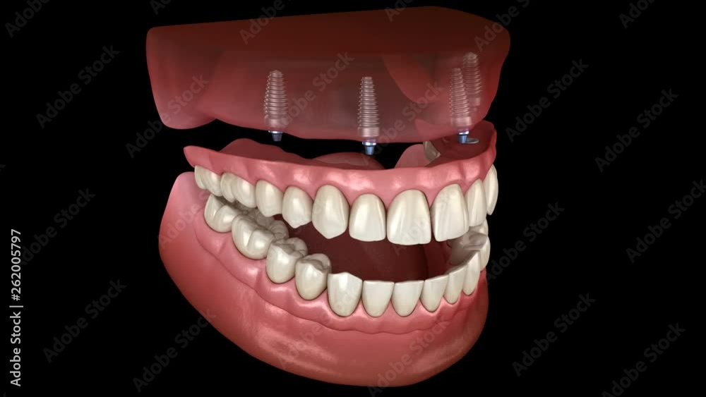 Maxillary prosthesis All on 4 system supported by implants. Medically ...