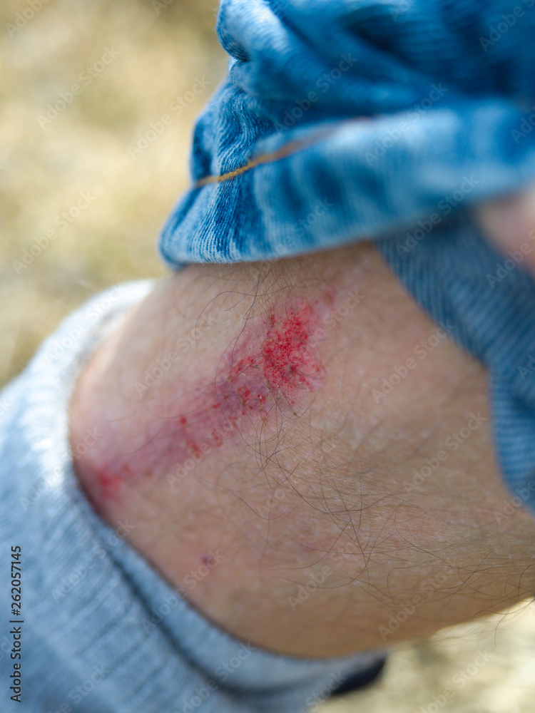 Emergency accident open abrasion wound trauma skin leg Stock Photo ...