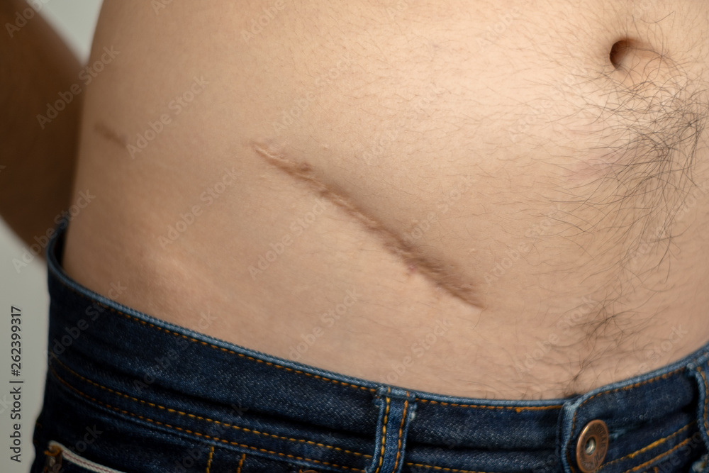 Man showing the stomach with a scar from appendicitis surgery ...