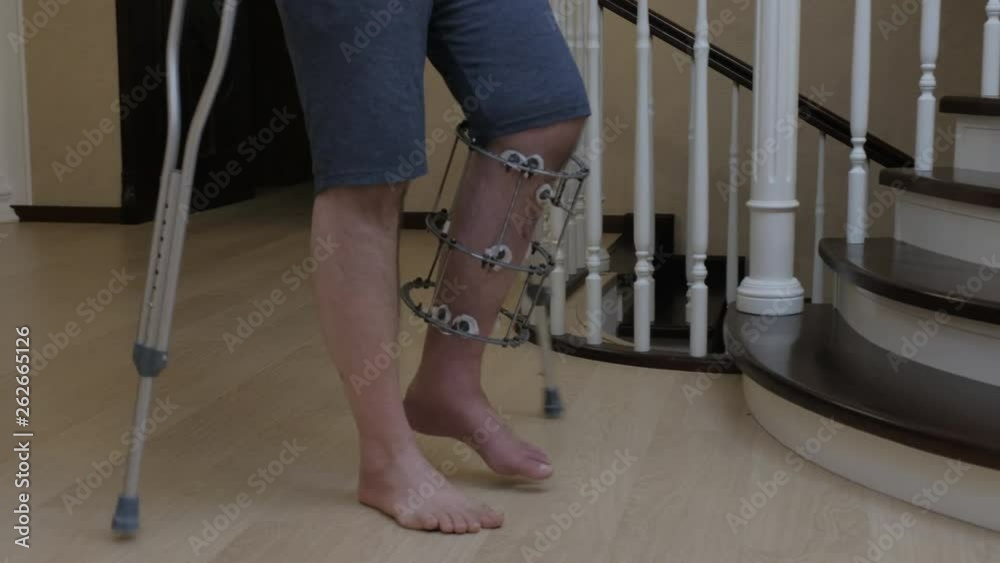Climbing the stairs on crutches with a broken leg in the Ilizarov's ...