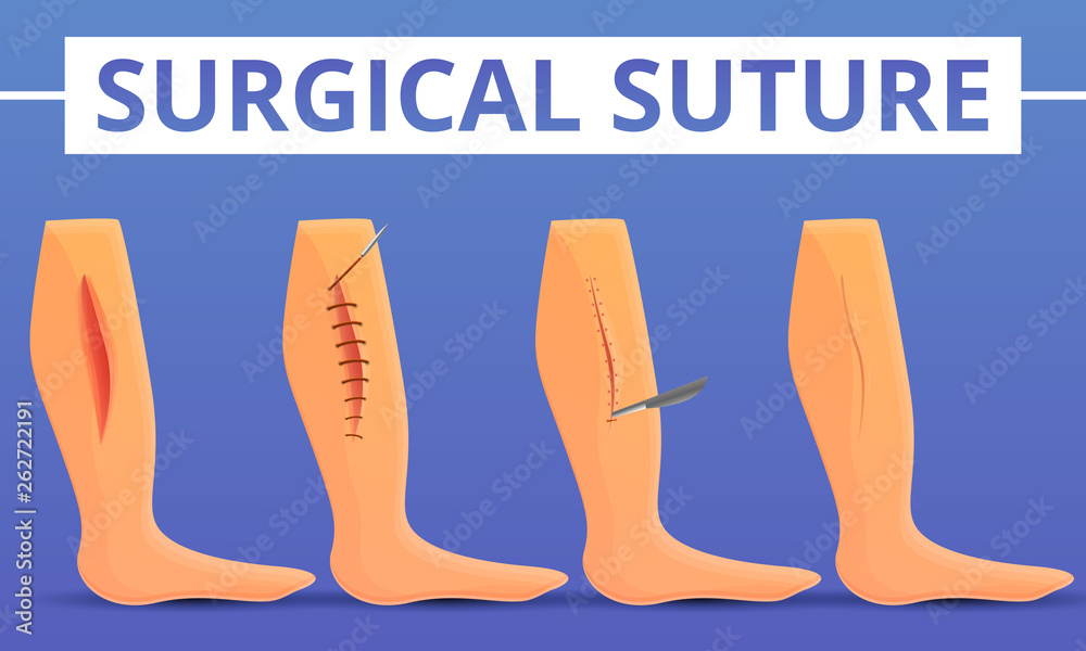 Medical suture concept background. Cartoon illustration of medical ...