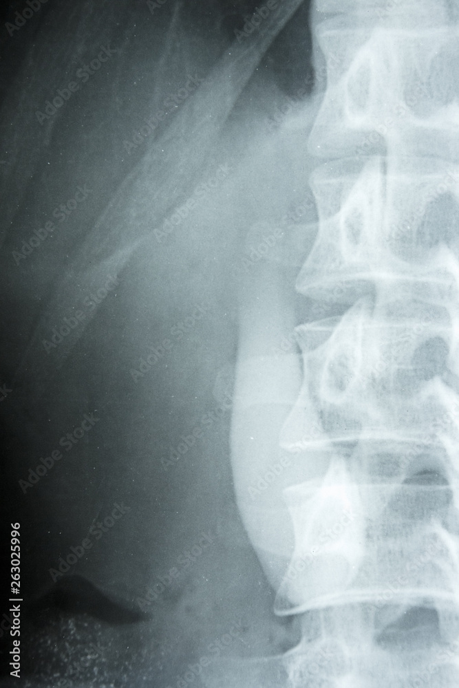 X-ray of the gallbladder and bones of the human vertical column. Stock ...