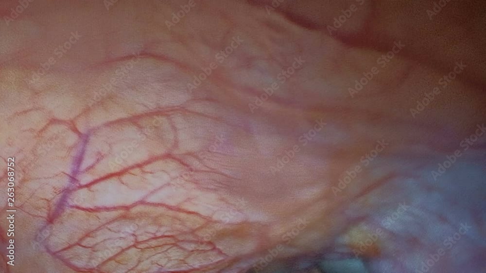 Endovideosurgery. Laparoscopy. View video camera inside the abdominal ...