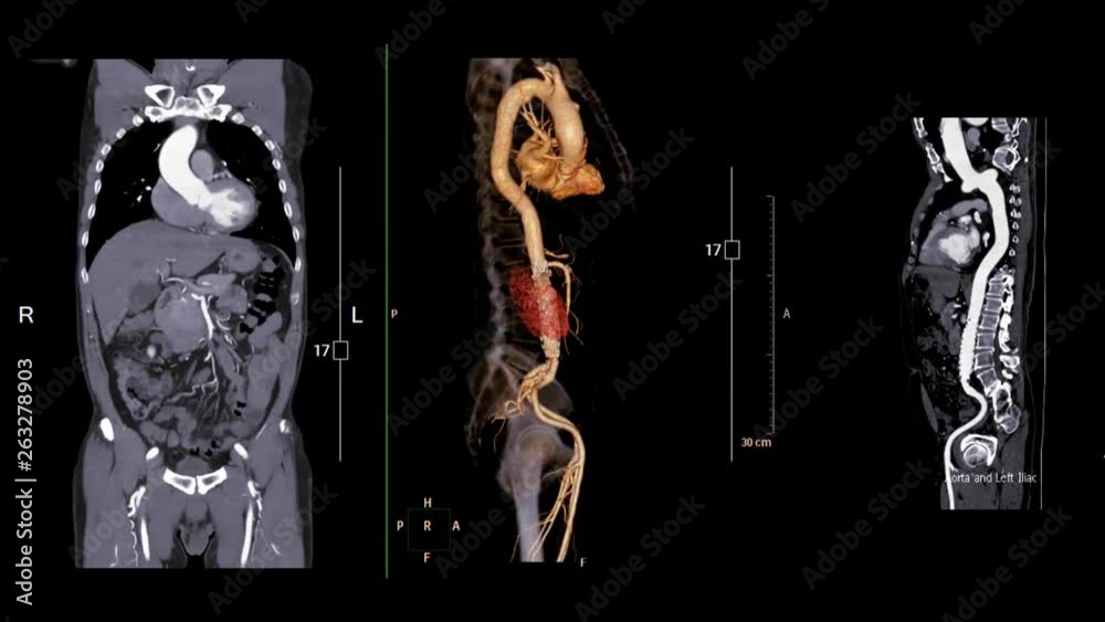 CTA abdominal aorta comparison coronal plane, 3D rendering image and ...
