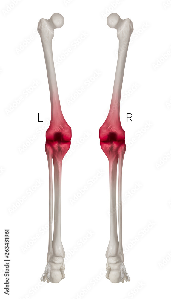 Human Leg bone left and right- Posterior view red highlights in ...