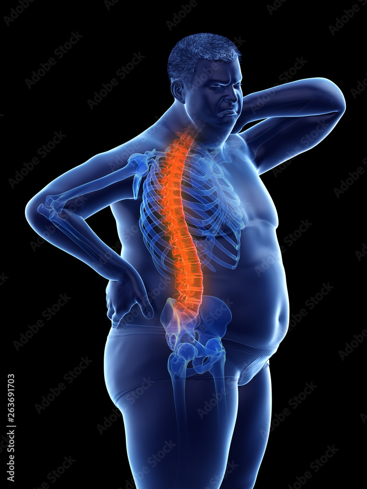 3d rendered medically accurate illustration of an obese mans painful ...