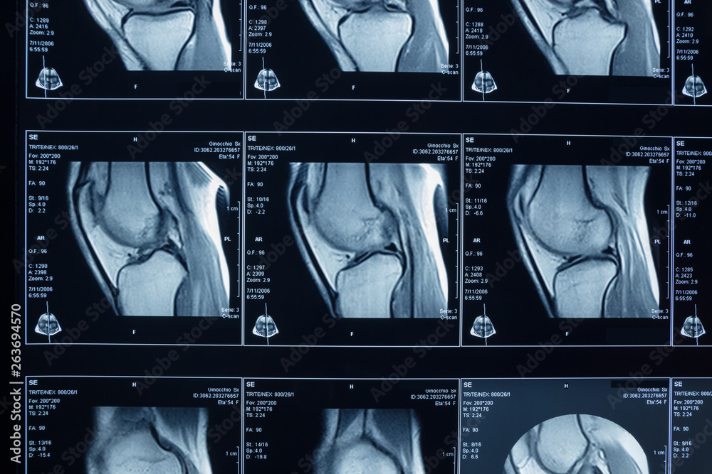 R.M.N. Nuclear magnetic resonance, of human knees, with cross-section ...