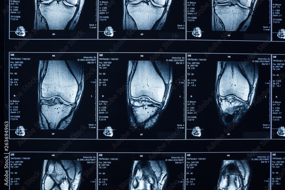 R.M.N. Nuclear magnetic resonance, of human knees, with cross-section ...