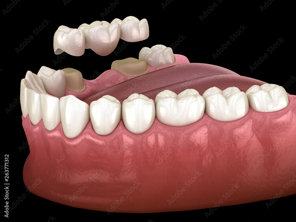 Dental bridge of 3 teeth over molar and premolar. Medically accurate 3D ...
