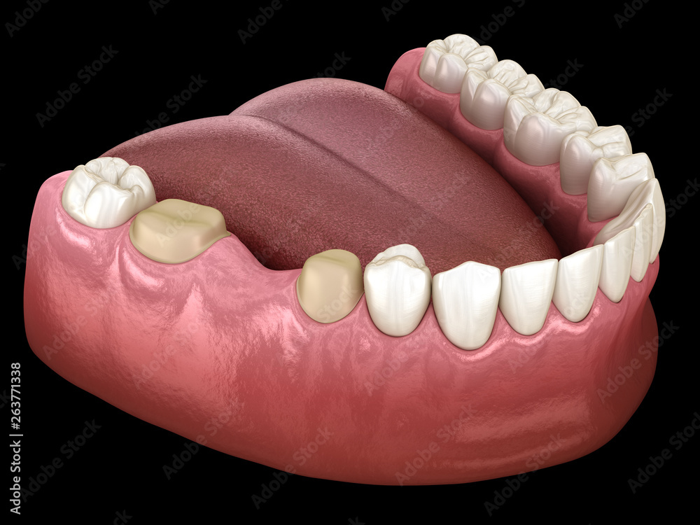 Foto de Preparated molar and premolar tooth for dental bridge placement ...