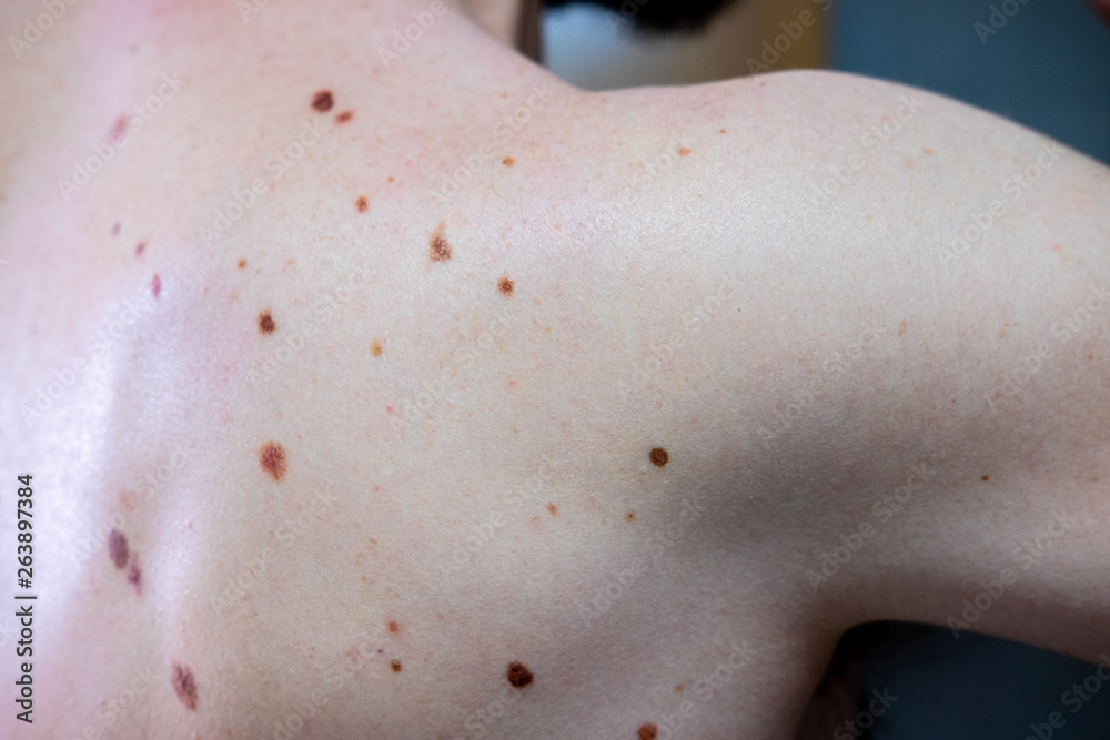 Melanocytic nevus, some of them dyplastic or atypical, on a caucasian ...