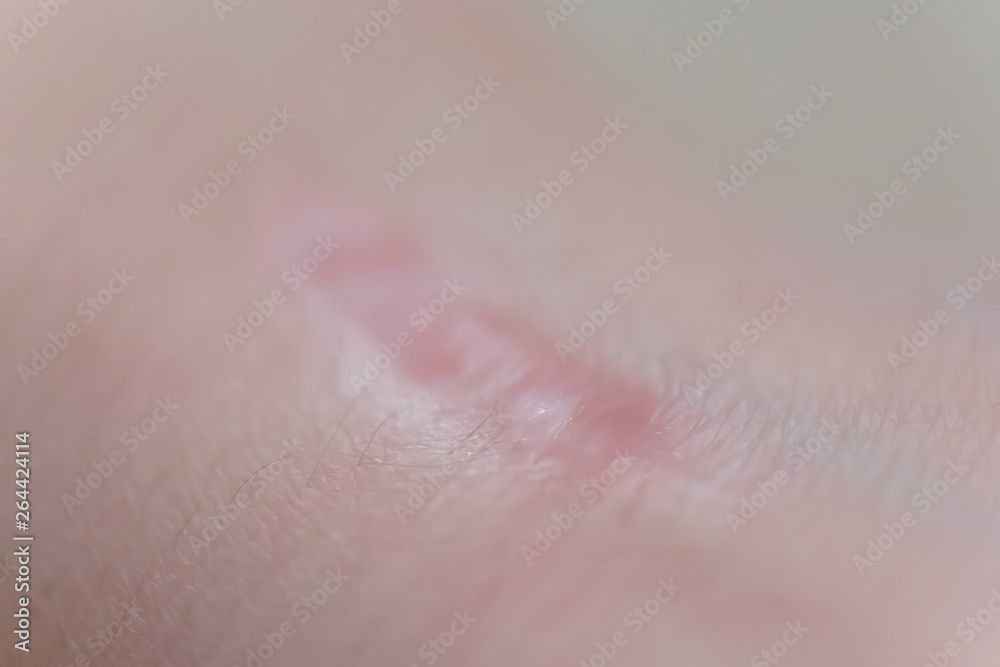Scar on the girl's wrist. The texture of the scar on the skin. The ...